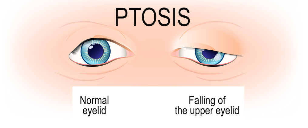 Drooping Eyelid Surgery Or Ptosis Surgery In Sydney